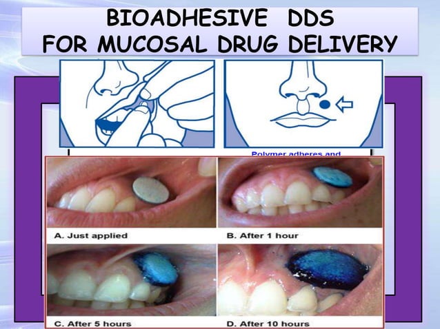 buccal drug delivery system | PPTX | Ear, Nose and Throat Conditions ...