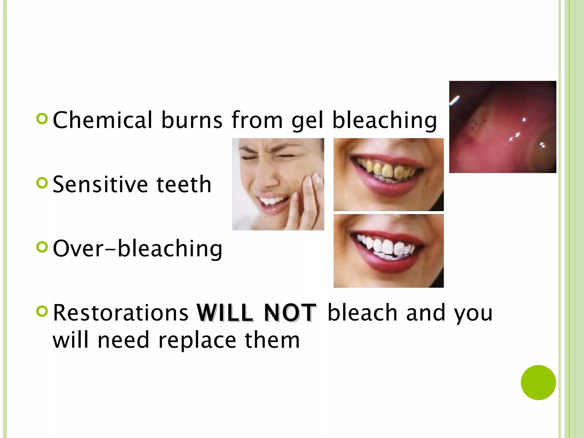 Dental Bleaching | PPT