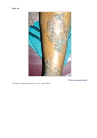 Darier disease | PDF