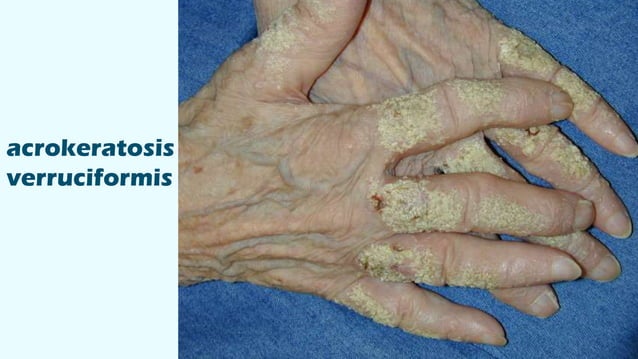 Darier’s Disease | PPTX | Skin and Dermatology | Diseases and Conditions