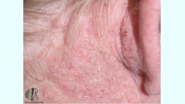 Darier’s Disease