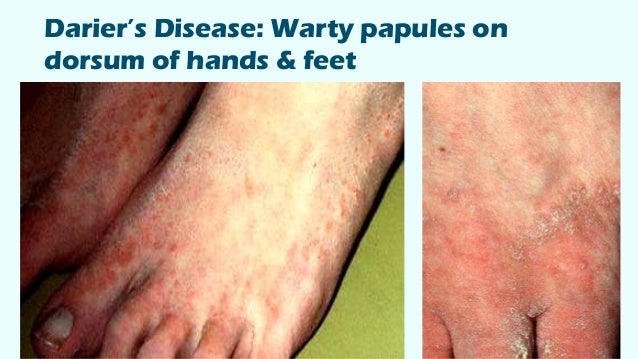 Darier’s Disease