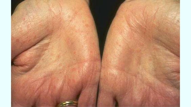 Darier’s Disease