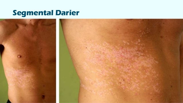 Darier’s Disease