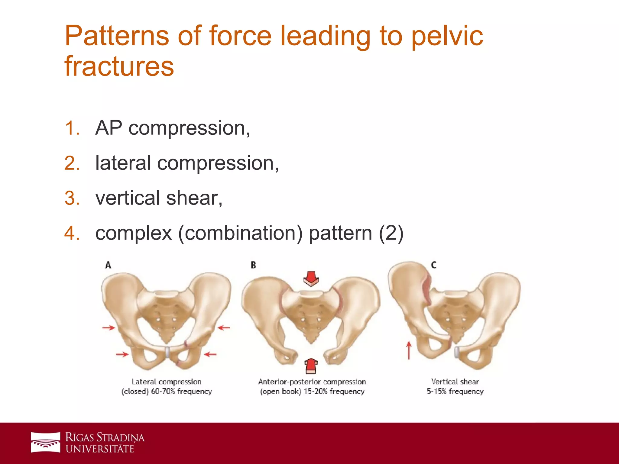 Presacral venous plexus bleeding in patients with pelvic fractures | PPT