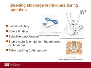 Presacral venous plexus bleeding in patients with pelvic fractures | PPT