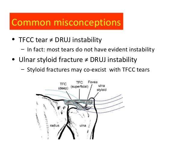 Οξείες Ρήξεις Τρίγωνου Χόνδρου- Acute TFCC Tears 2015