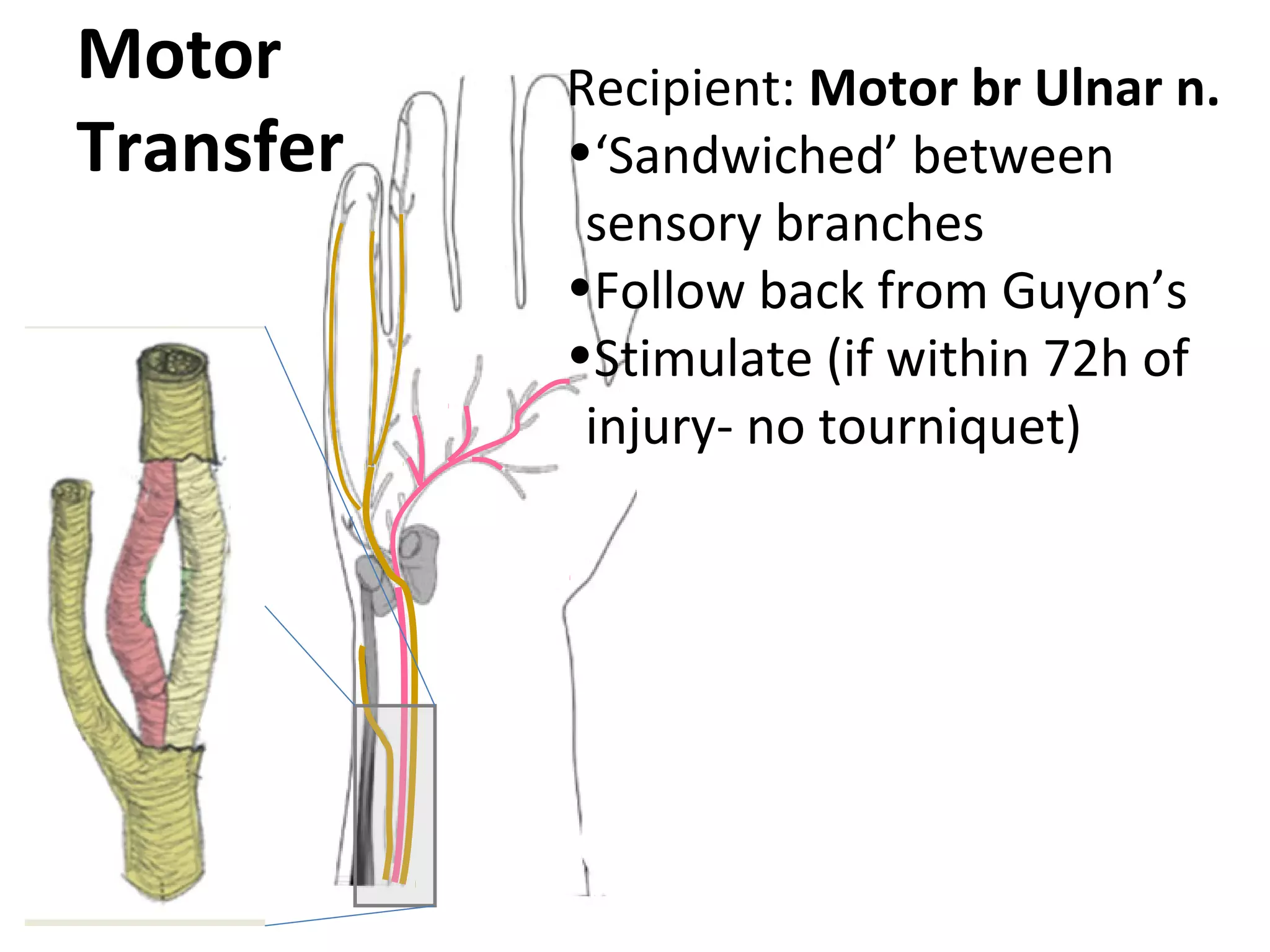 Περιφερικές Νευρομεταφορές για βλάβες του Ωλενίου Νεύρου- Distal Nerve transfers for Ulnar n ...