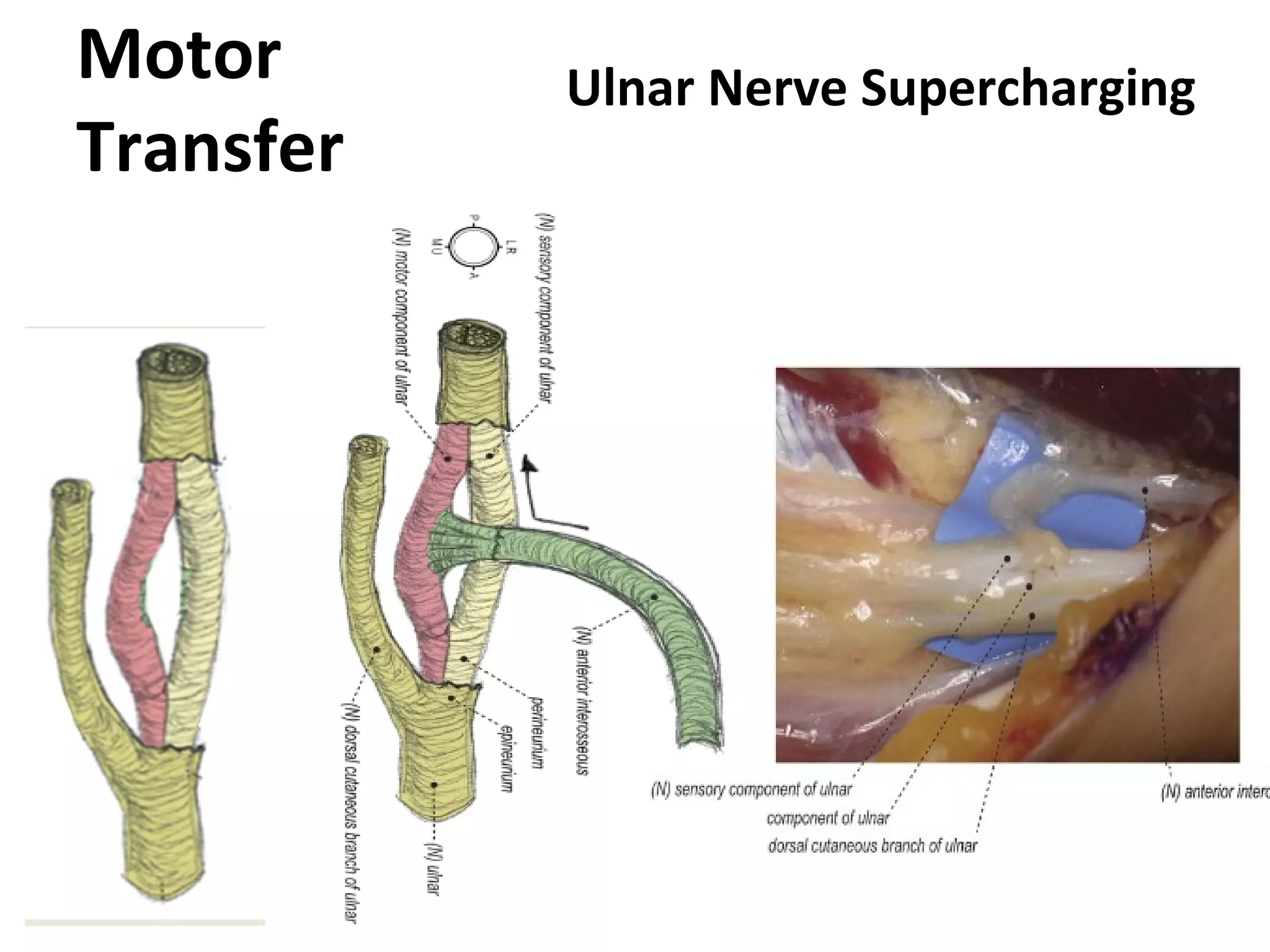 Περιφερικές Νευρομεταφορές για βλάβες του Ωλενίου Νεύρου- Distal Nerve transfers for Ulnar n ...
