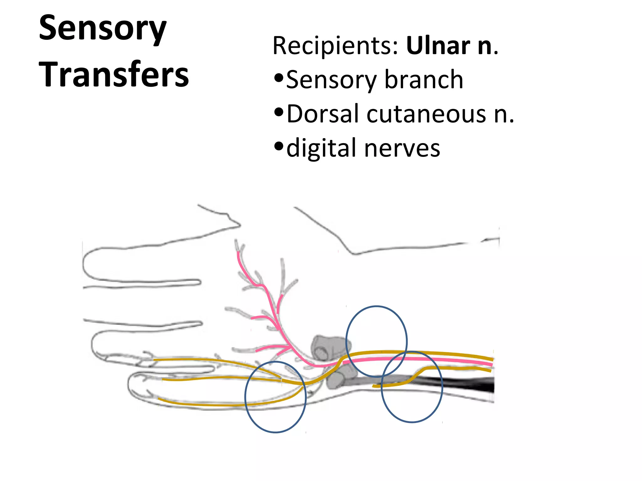 Περιφερικές Νευρομεταφορές για βλάβες του Ωλενίου Νεύρου- Distal Nerve transfers for Ulnar n ...