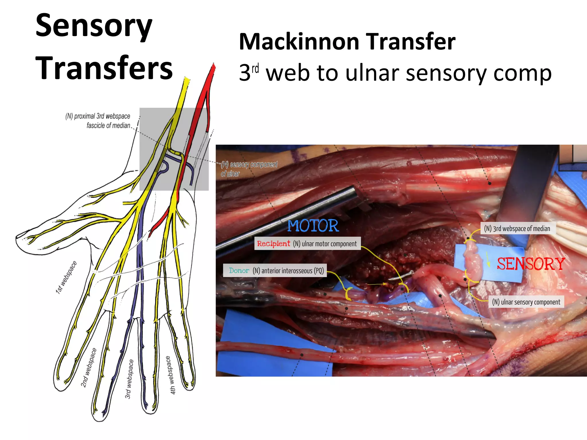 Περιφερικές Νευρομεταφορές για βλάβες του Ωλενίου Νεύρου- Distal Nerve transfers for Ulnar n ...
