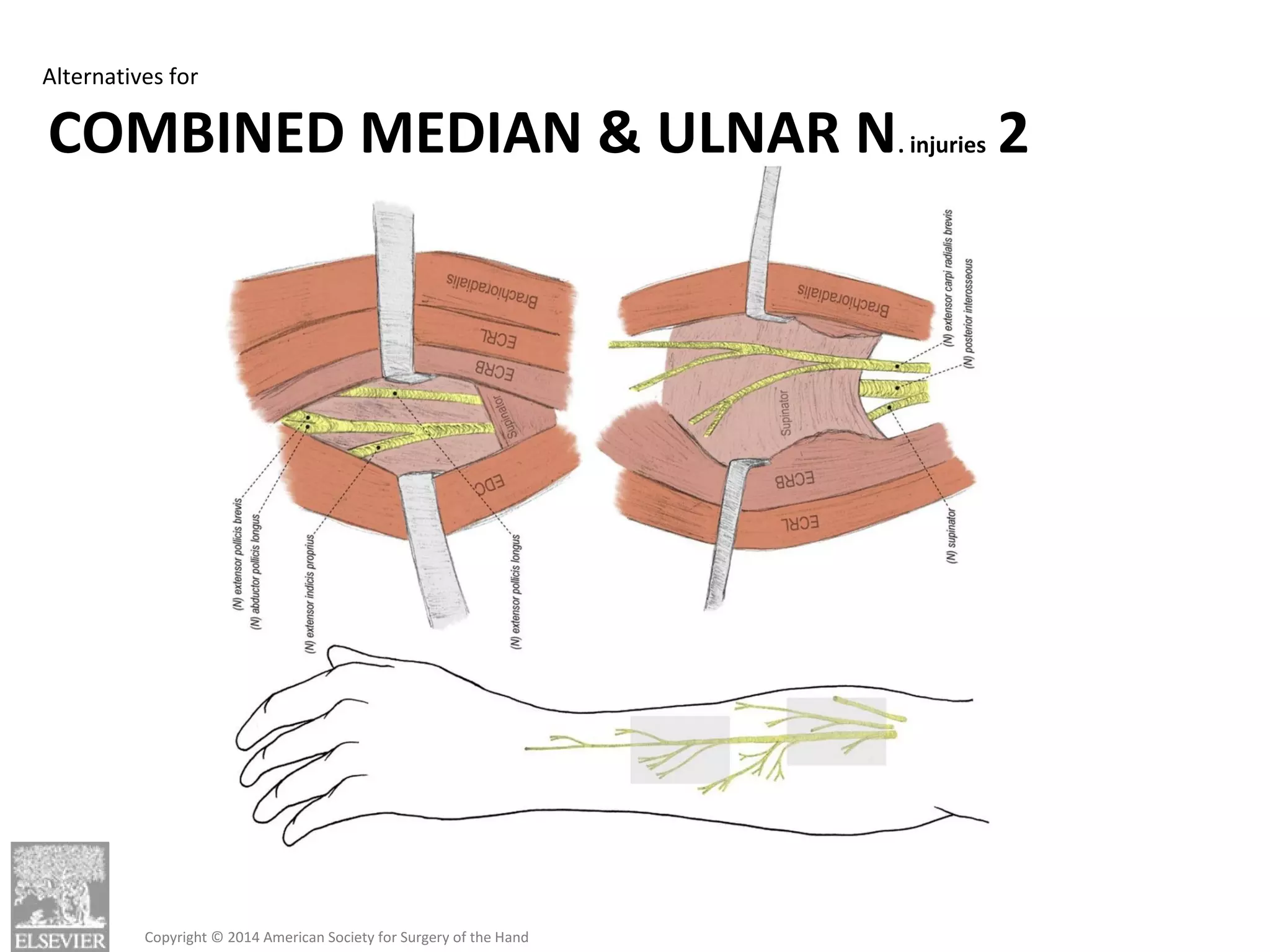 Περιφερικές Νευρομεταφορές για βλάβες του Ωλενίου Νεύρου- Distal Nerve transfers for Ulnar n ...