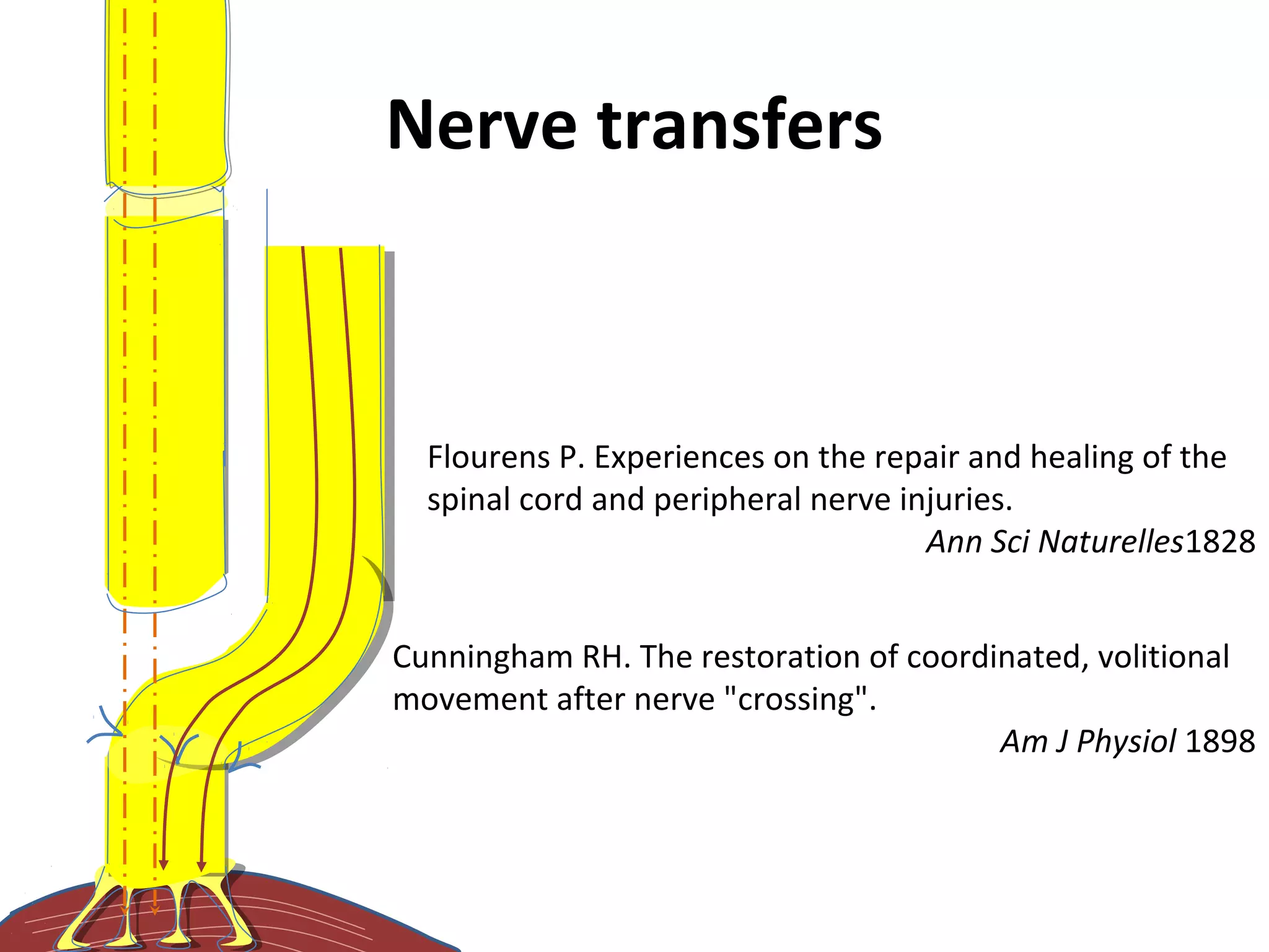 Περιφερικές Νευρομεταφορές για βλάβες του Ωλενίου Νεύρου- Distal Nerve ...