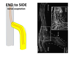 Περιφερικές Νευρομεταφορές για βλάβες του Ωλενίου Νεύρου- Distal Nerve ...