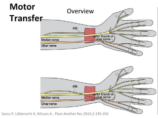 Περιφερικές Νευρομεταφορές για βλάβες του Ωλενίου Νεύρου- Distal Nerve ...