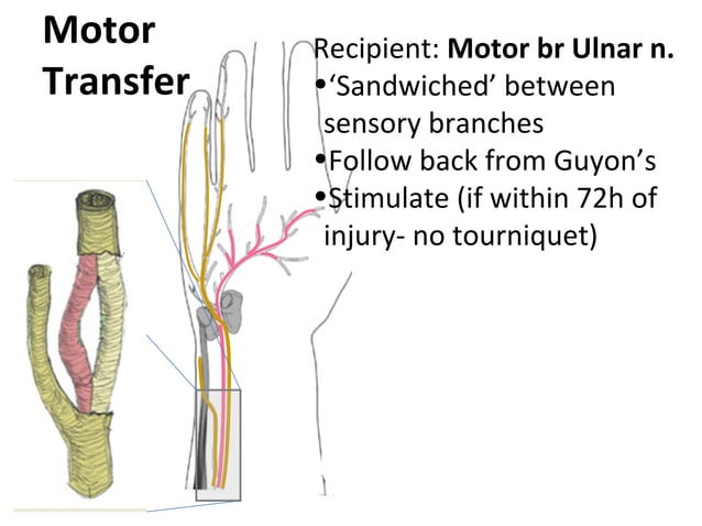 Περιφερικές Νευρομεταφορές για βλάβες του Ωλενίου Νεύρου- Distal Nerve ...