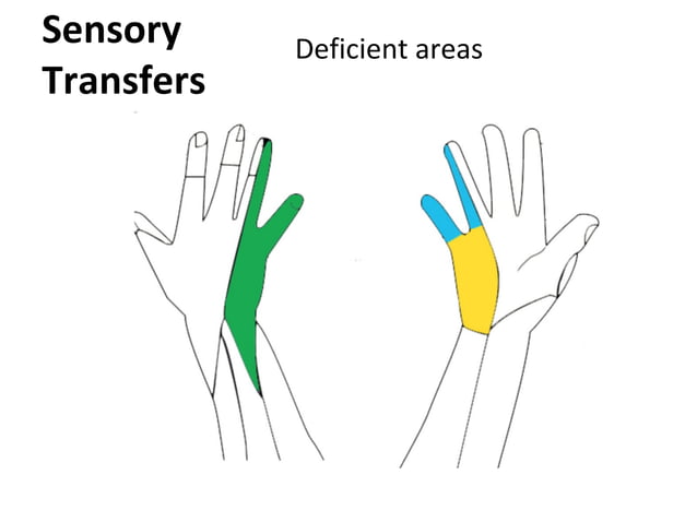 Περιφερικές Νευρομεταφορές για βλάβες του Ωλενίου Νεύρου- Distal Nerve ...