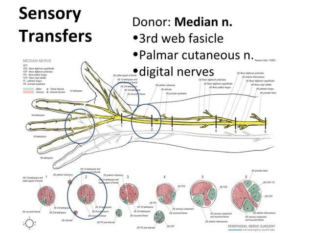 Περιφερικές Νευρομεταφορές για βλάβες του Ωλενίου Νεύρου- Distal Nerve ...