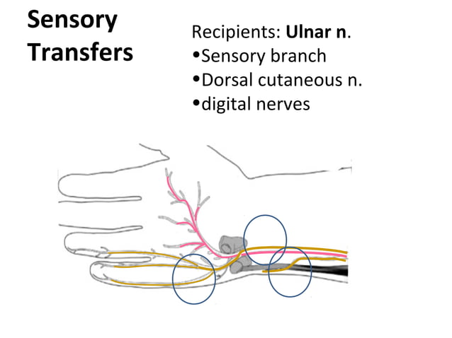 Περιφερικές Νευρομεταφορές για βλάβες του Ωλενίου Νεύρου- Distal Nerve ...