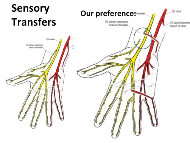 Περιφερικές Νευρομεταφορές για βλάβες του Ωλενίου Νεύρου- Distal Nerve ...