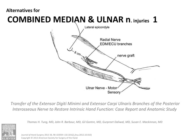 Περιφερικές Νευρομεταφορές για βλάβες του Ωλενίου Νεύρου- Distal Nerve transfers for Ulnar n ...