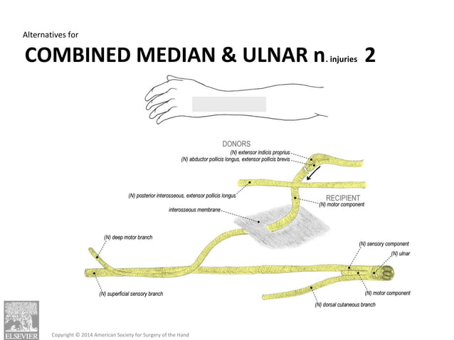 Περιφερικές Νευρομεταφορές για βλάβες του Ωλενίου Νεύρου- Distal Nerve transfers for Ulnar n ...