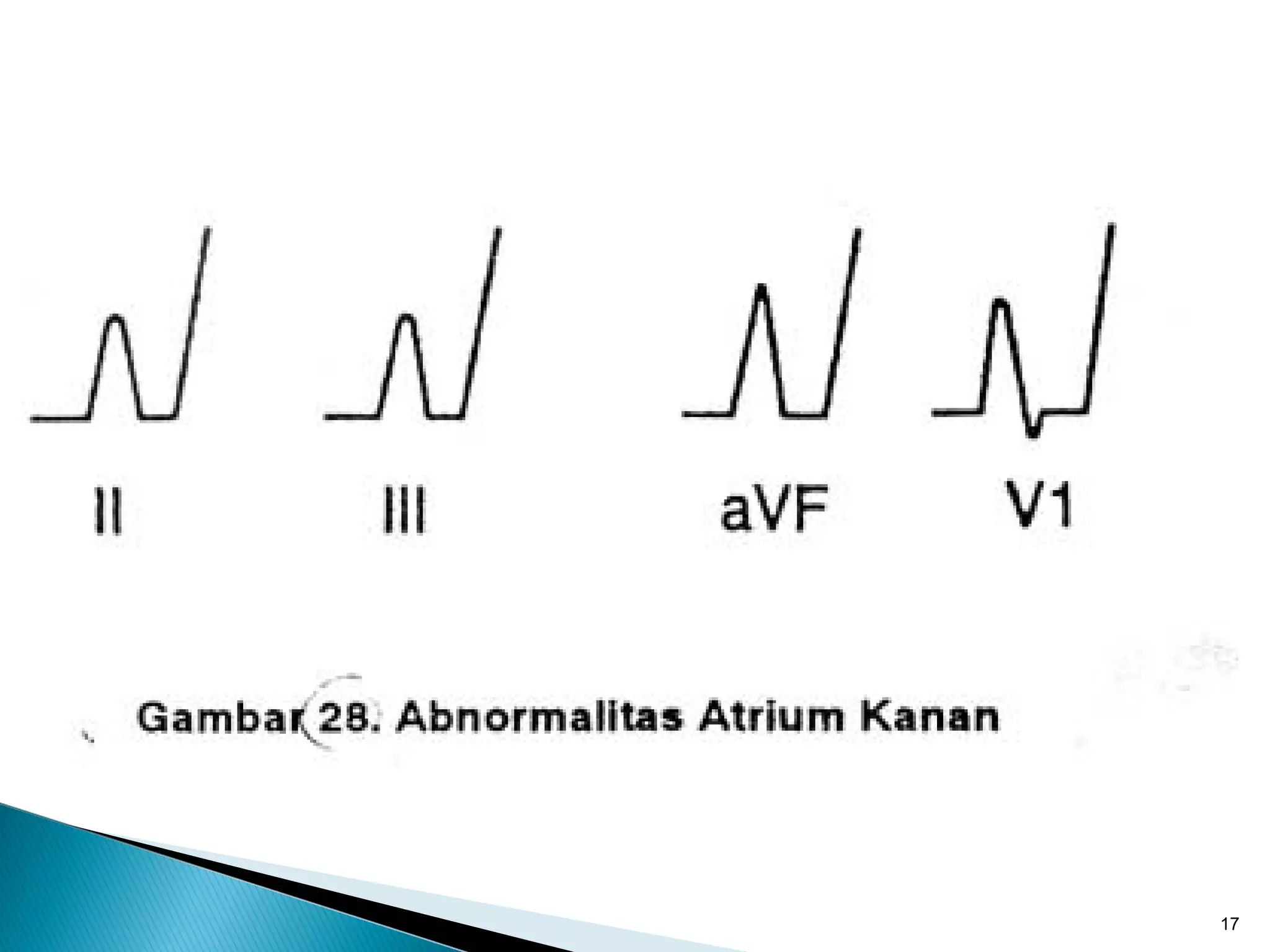 Dasar dasar ekg fix | PPT