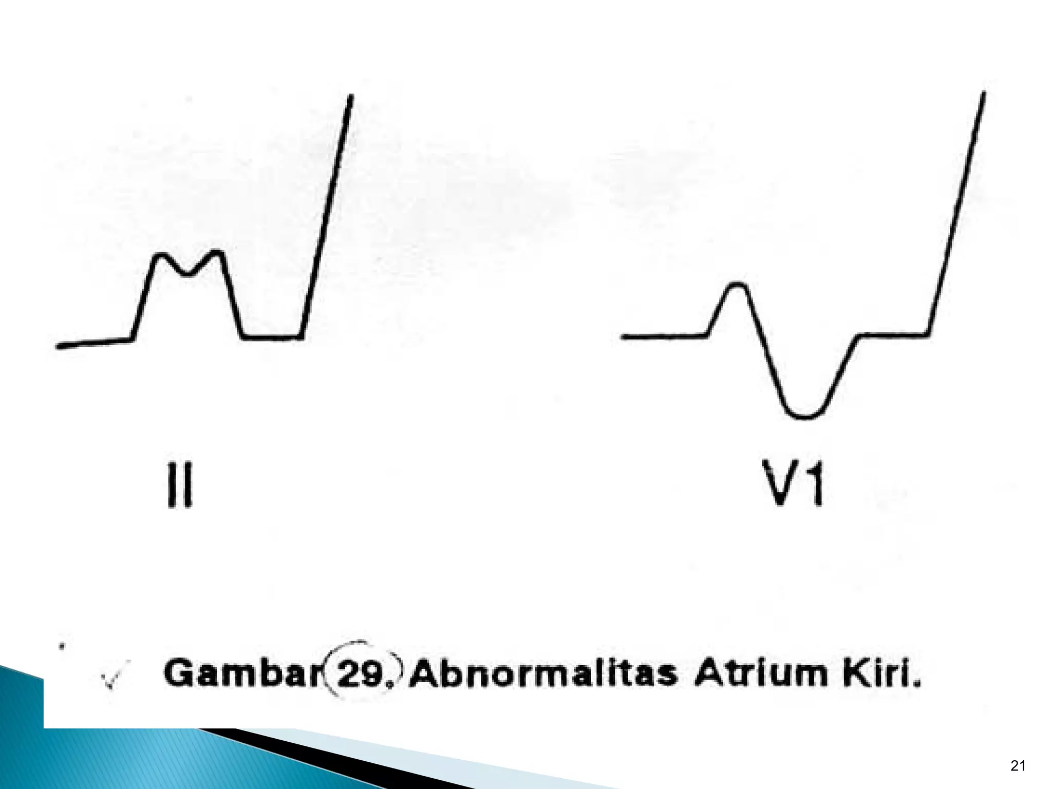 Dasar dasar ekg fix | PPT