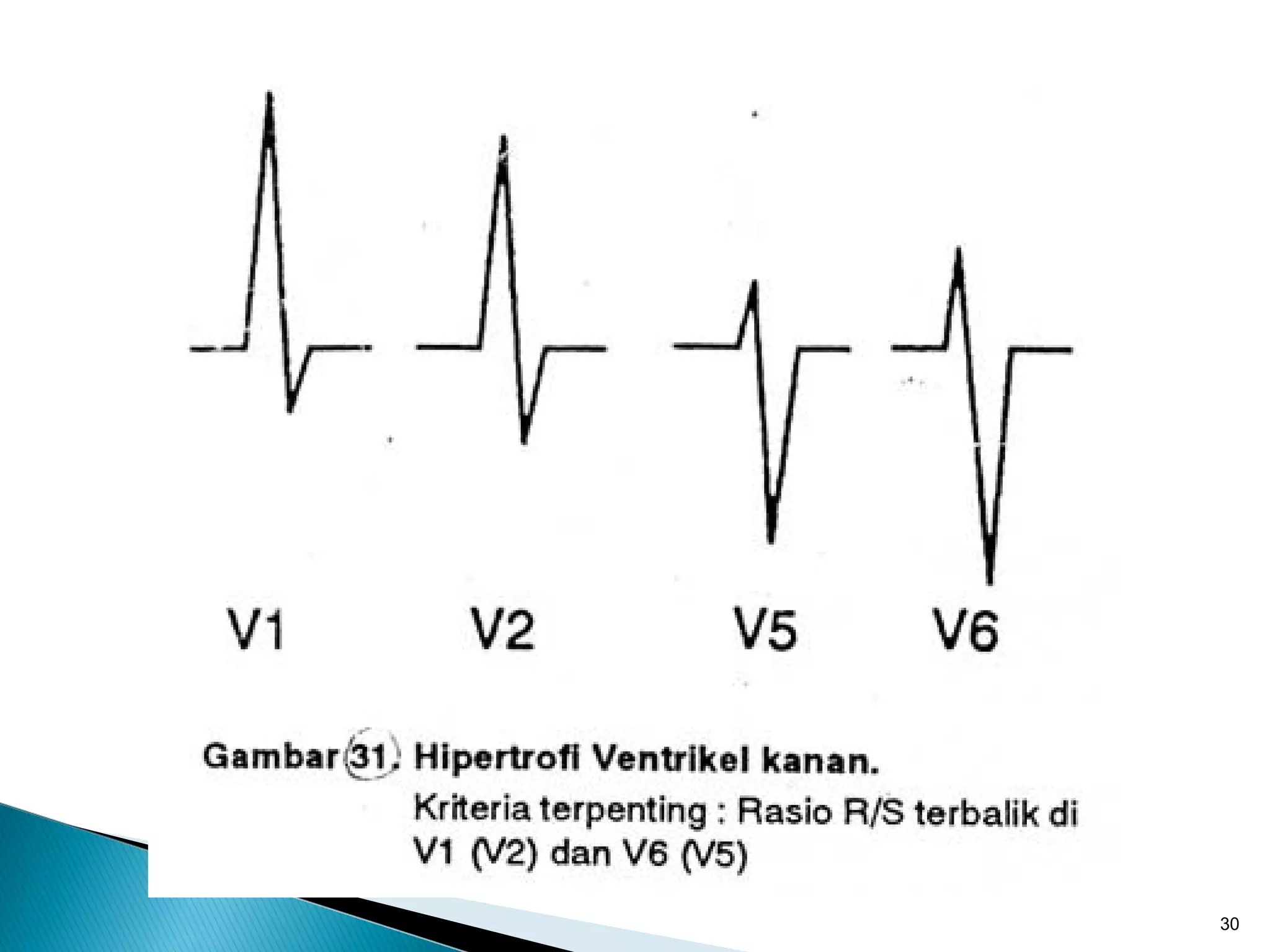 Dasar dasar ekg fix | PPT