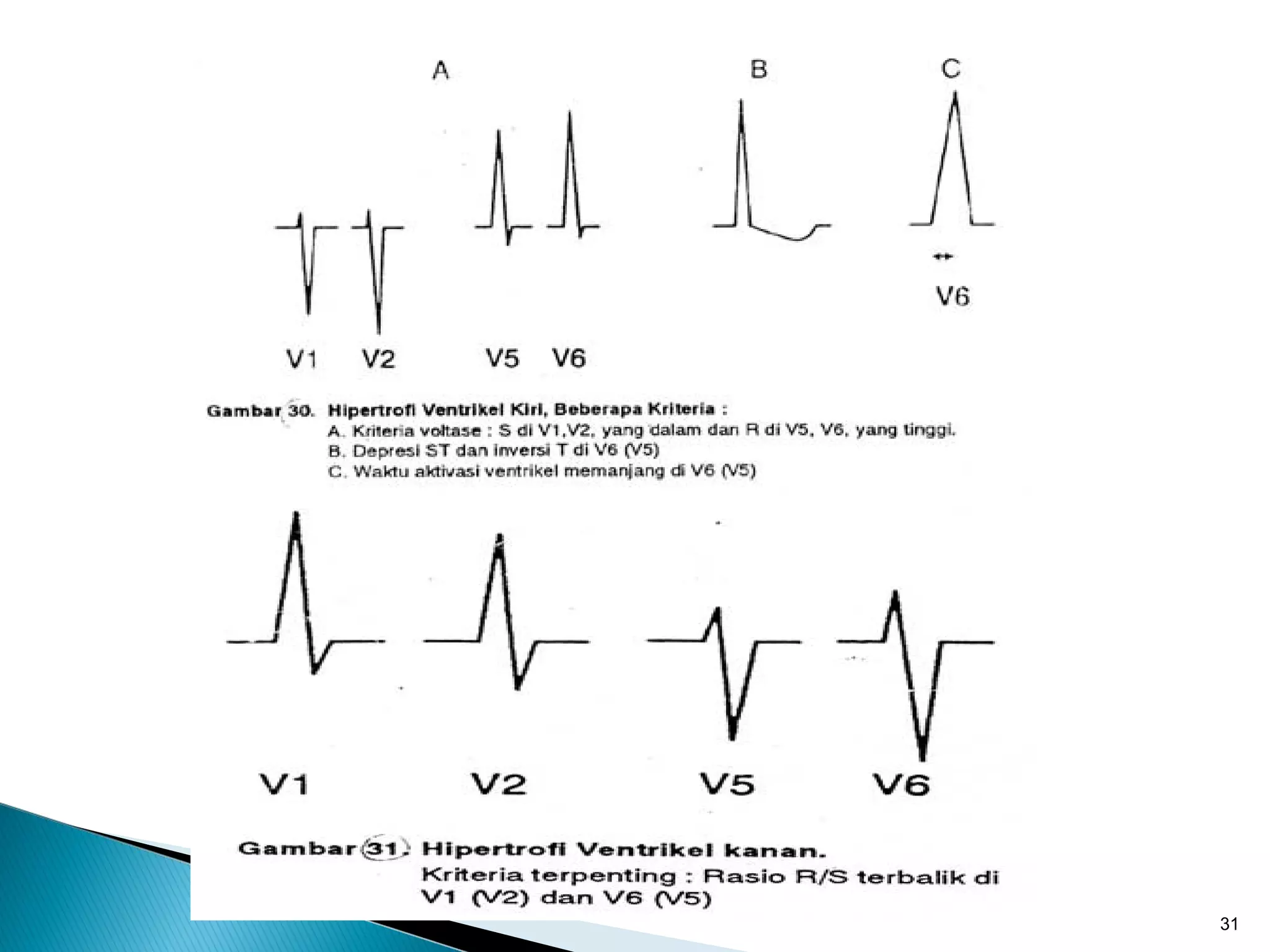 Dasar dasar ekg fix | PPT