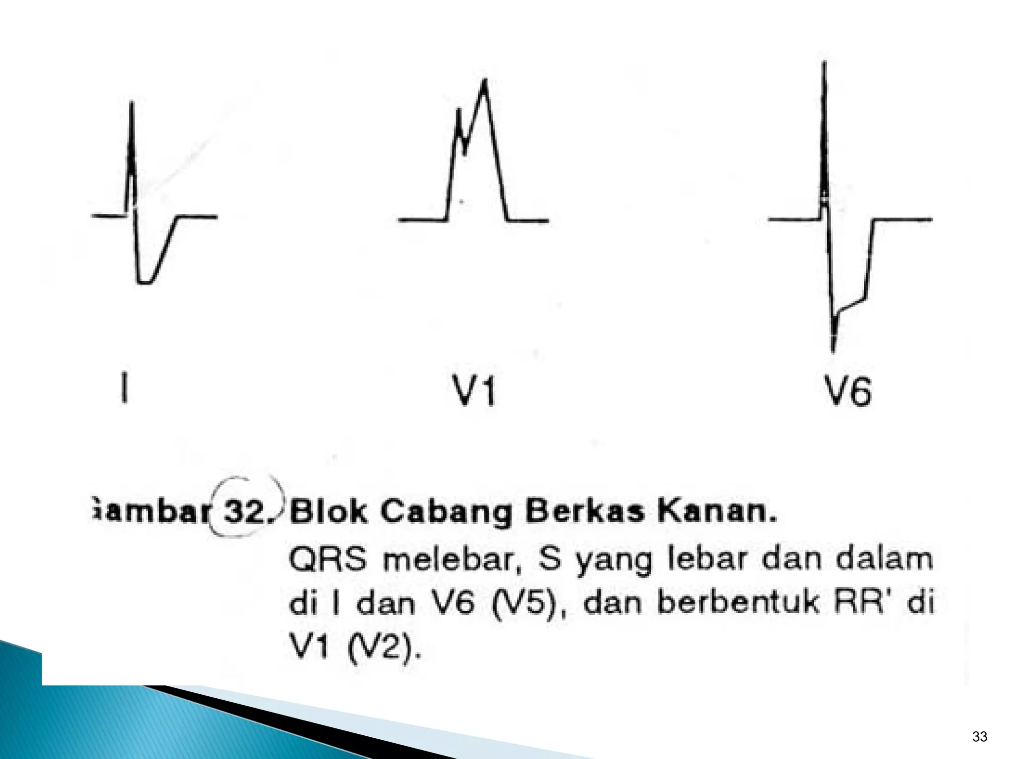 Dasar dasar ekg fix | PPT