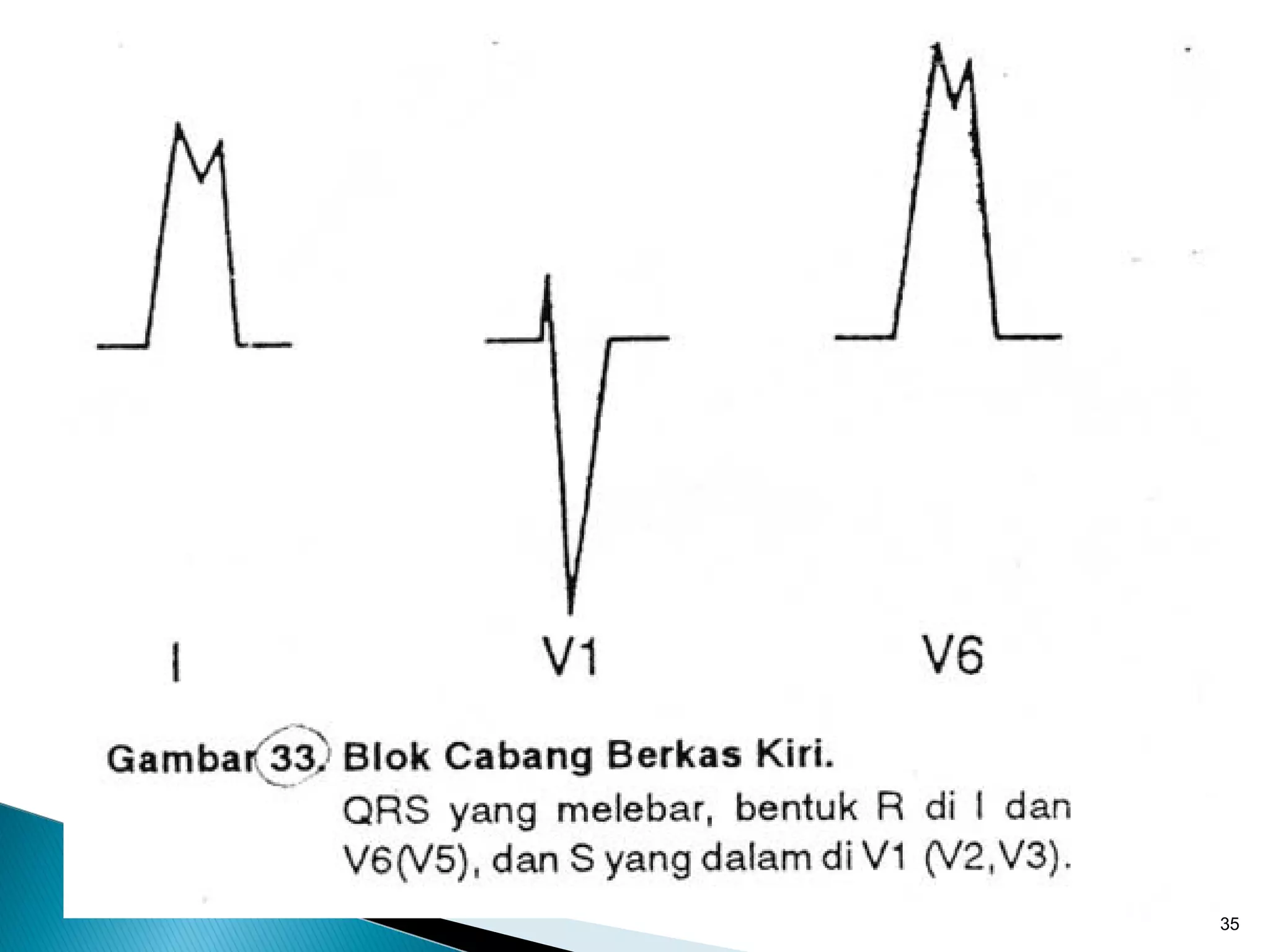 Dasar dasar ekg fix | PPT