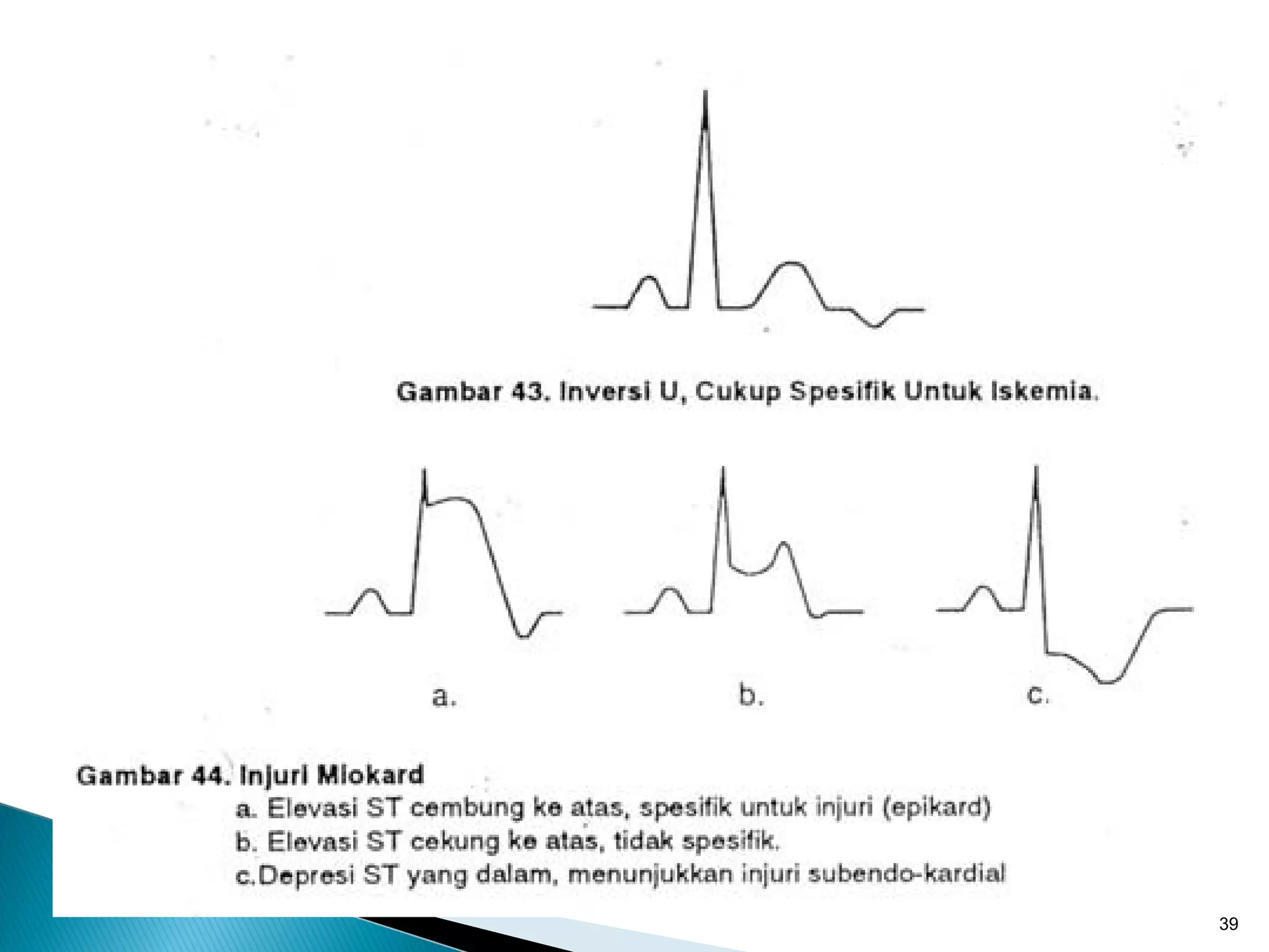 Dasar dasar ekg fix | PPT