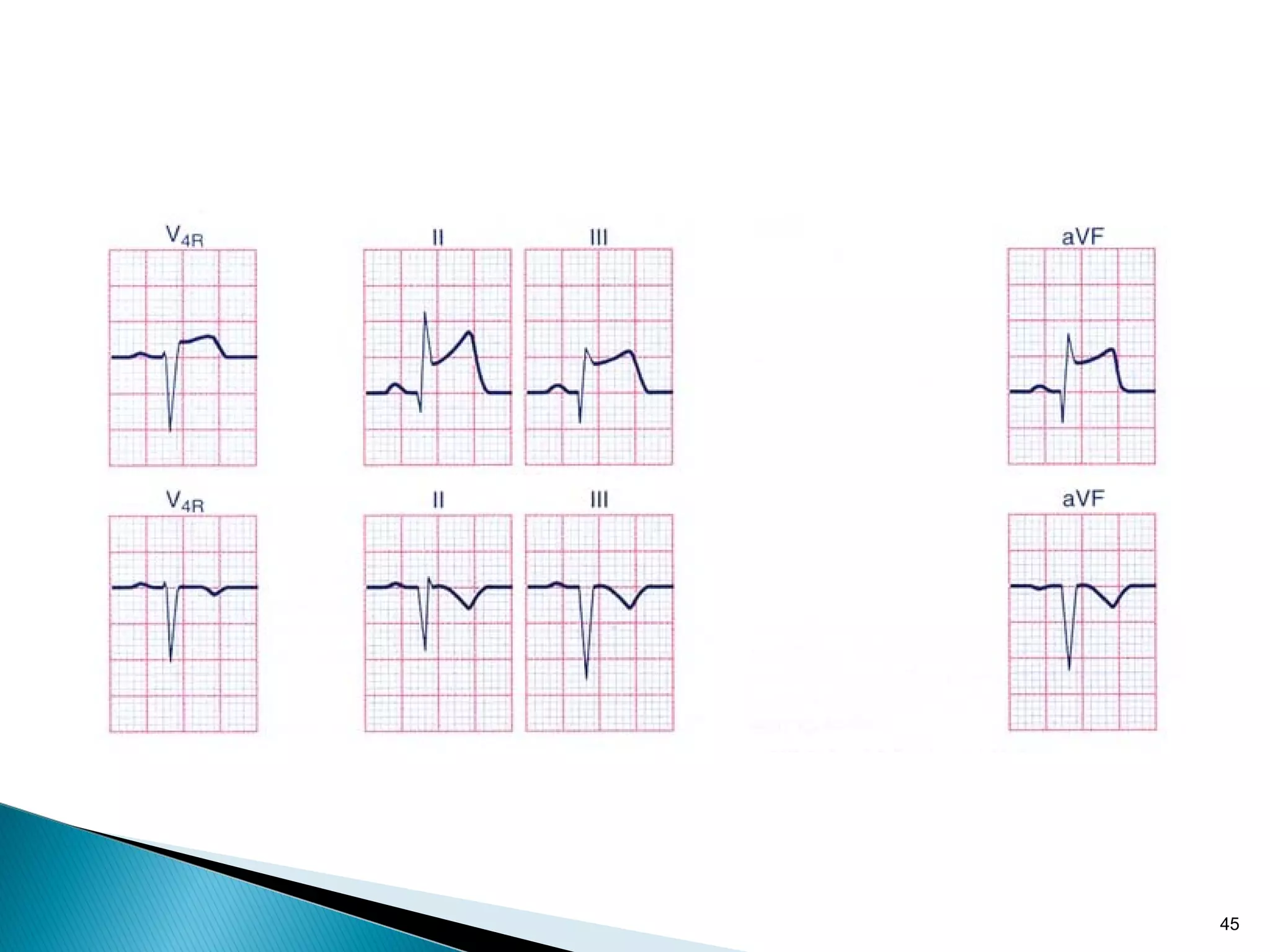 Dasar dasar ekg fix | PPT