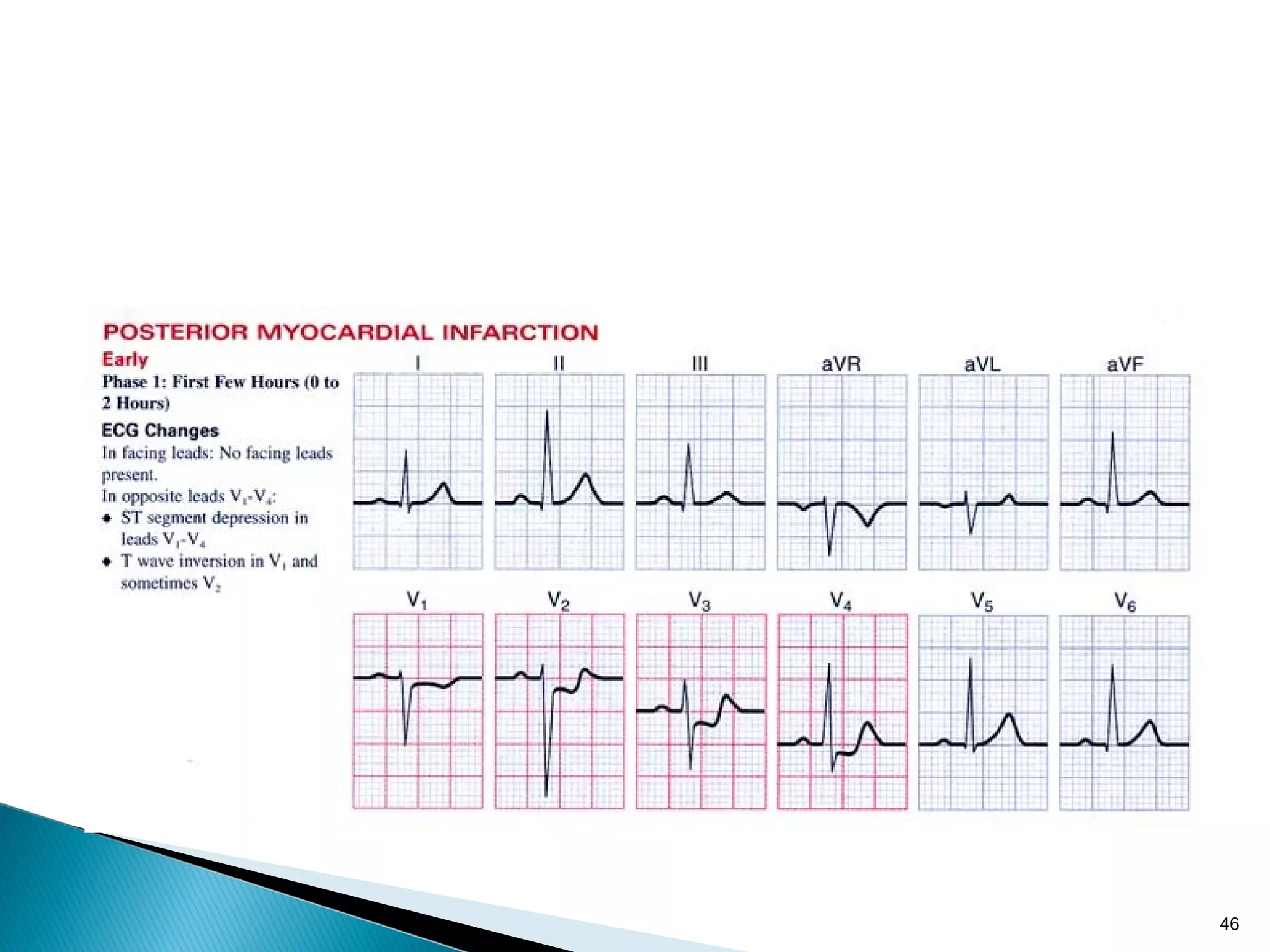 Dasar dasar ekg fix | PPT