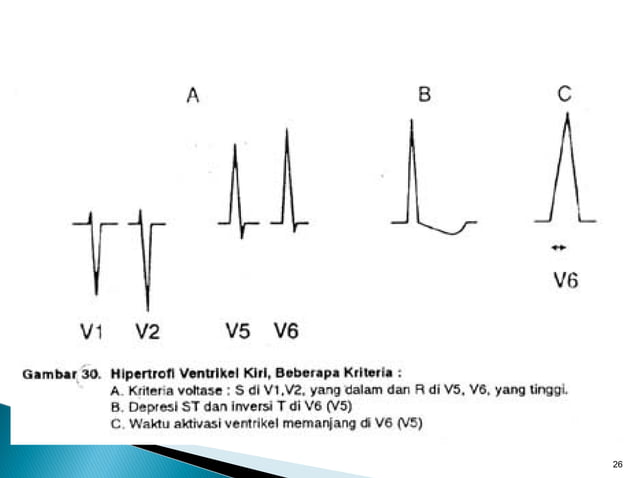 Dasar dasar ekg fix | PPT