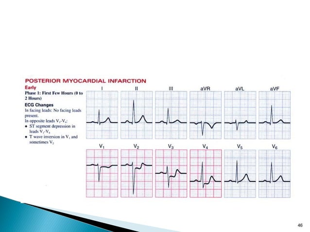 Dasar dasar ekg fix | PPT