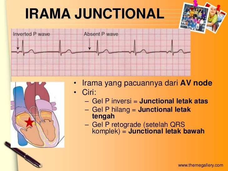 Dasar interprestasi ekg