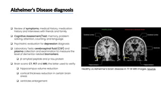 Identification Of Alzheimer's Disease Using A Deep Learning Method ...