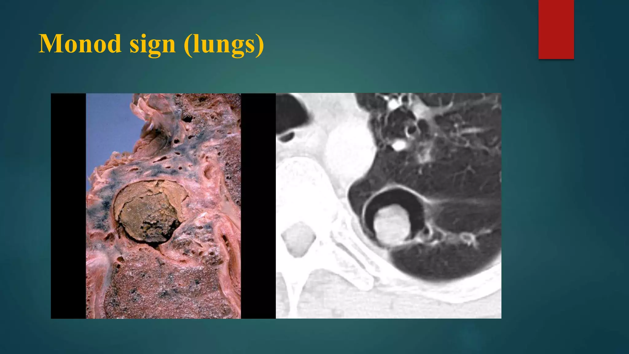 Dau hieu x quang ngực (signsinchestxray) | PDF