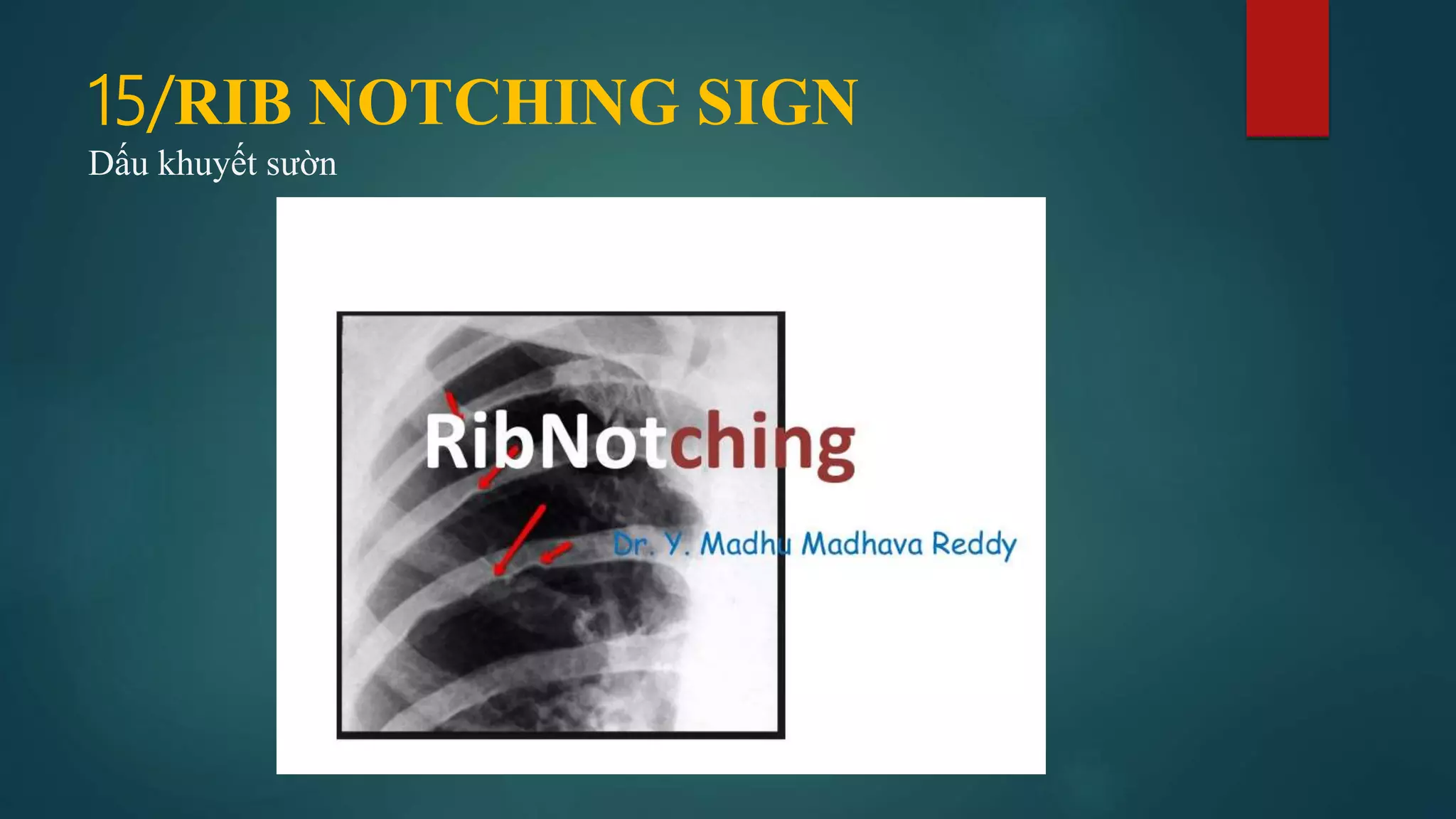 Dau hieu x quang ngực (signsinchestxray) | PDF