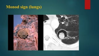 Dau hieu x quang ngực (signsinchestxray) | PDF