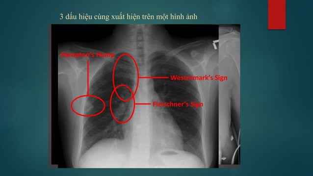 Dau hieu x quang ngực (signsinchestxray) | PDF