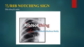 Dau hieu x quang ngực (signsinchestxray) | PDF