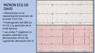 Davd ( Displasia Arritmogenica del Ventrículo Derecho) | PPTX