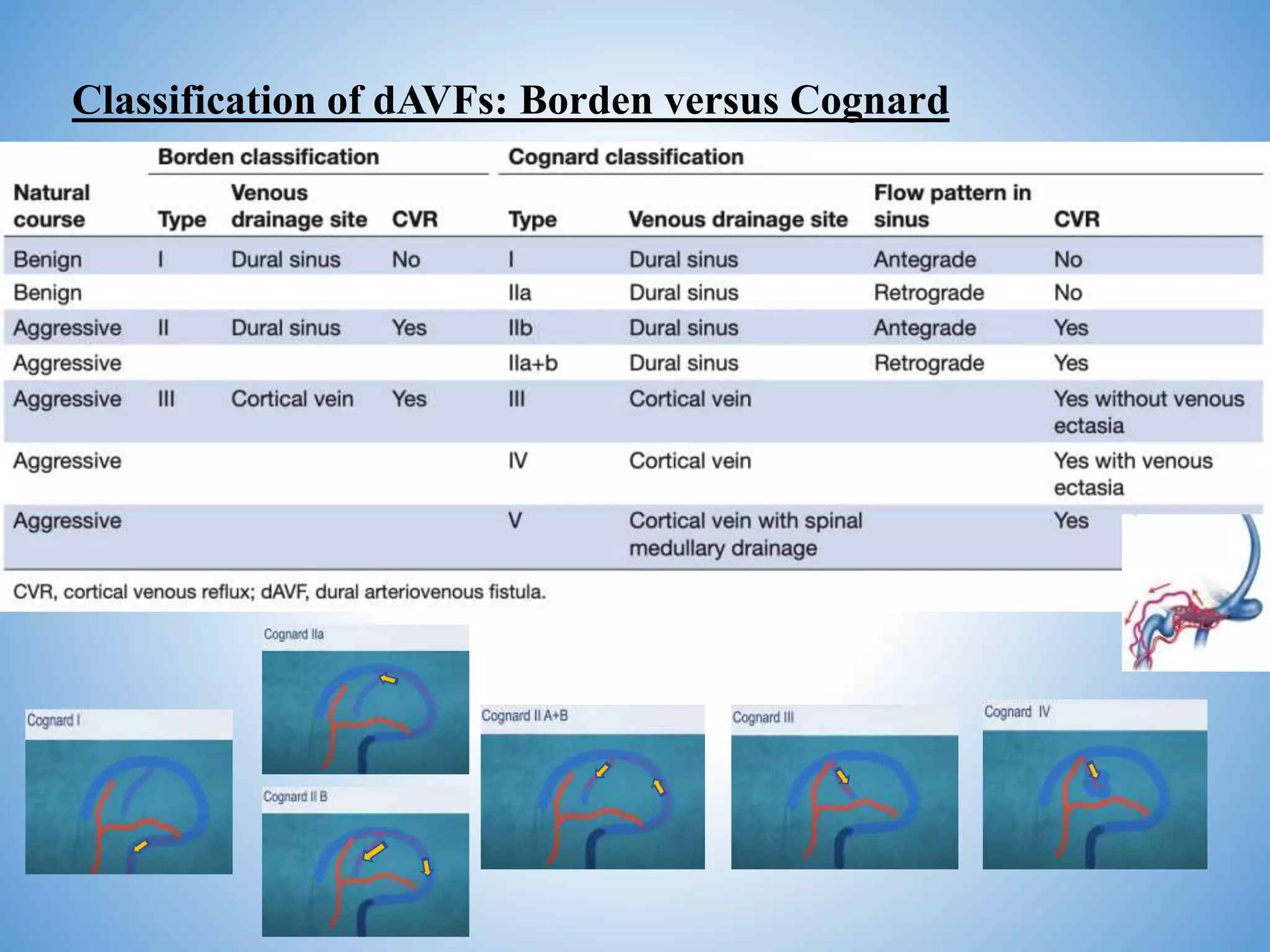 Dural arteriovenous fistula | PPTX
