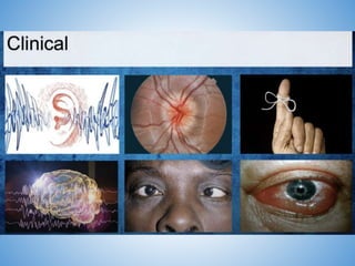Dural arteriovenous fistula | PPTX