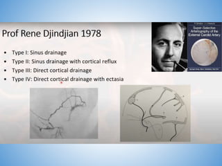 Dural arteriovenous fistula | PPTX