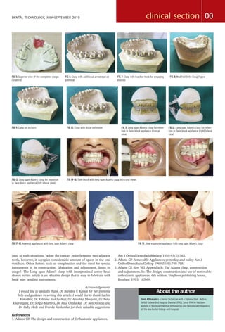 LONG SPAN ADAM’SCLASP WITH INTERPROXIMAL ARROW HEAD | PDF | Oral care ...