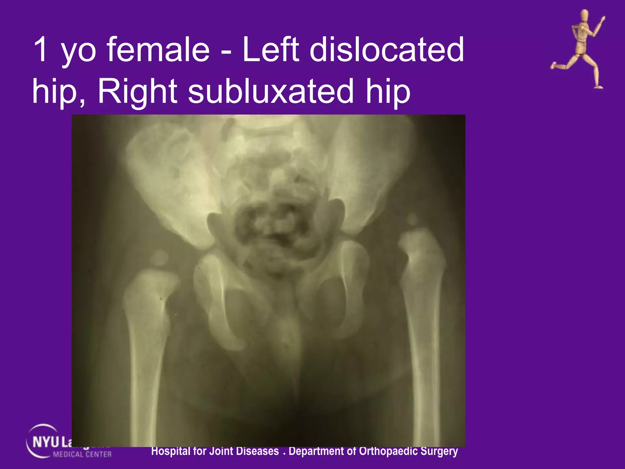 The Hip Joint in Cerebral Palsy | David S. Feldman, MD | PPTX